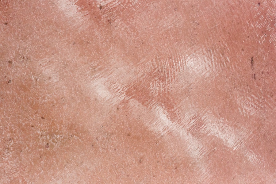 Kontaktni dermatitis: simptomi, uzroci i najbolje liječenje za osip i ...